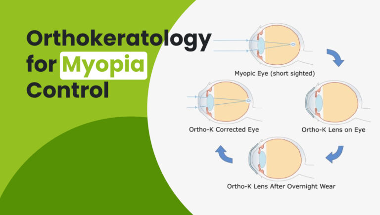 Orthokeratology for Myopia Control | Clear Vision Optical